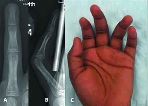 Proximal Phalanx Fracture Splint