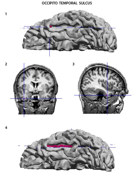 Inferior Temporal Sulcus