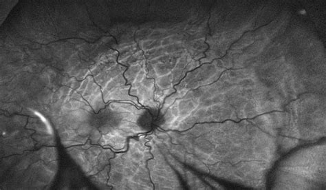 Hypotony Maculopathy Causes Diagnosis Treatment Obn