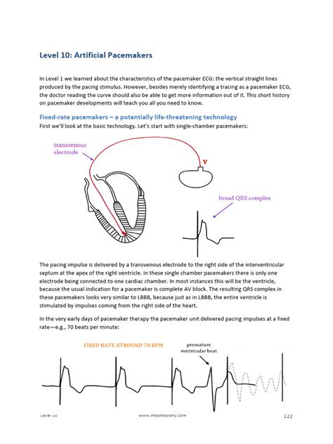Pacemakers Fact Sheet Pdf Artificial Cardiac Pacemaker Atrium