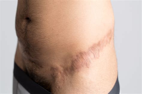 Phalloplasty Before And After