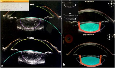 Segmentation Error Inset Using Intraoperative As Oct That Incorrectly Download Scientific