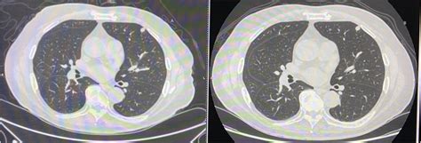 The Nonenhanced Pulmonary Nodule In The Anterior Segment Of The Left