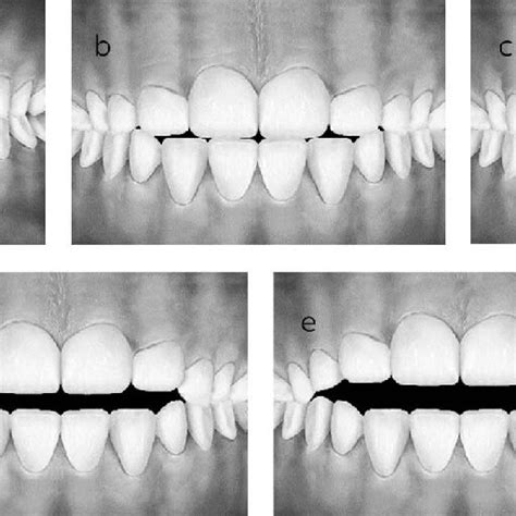 Series Of Images Showing Decreasing Overbite In 1 Mm Increments A