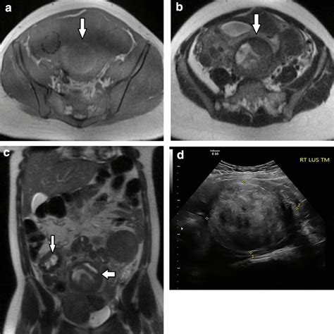 Fibroid Degeneration In Pregnancy Axial T1 A And T2wi B In A Download Scientific Diagram