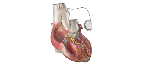 Conduction System Pacing Succeeds At Treating Av Block Cardiac Wire