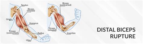 Distal Biceps Rupture Dr Saurabh Aggarwal