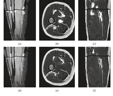 Figure 2 From Deep Learning Reconstruction Algorithm Based Mri Image