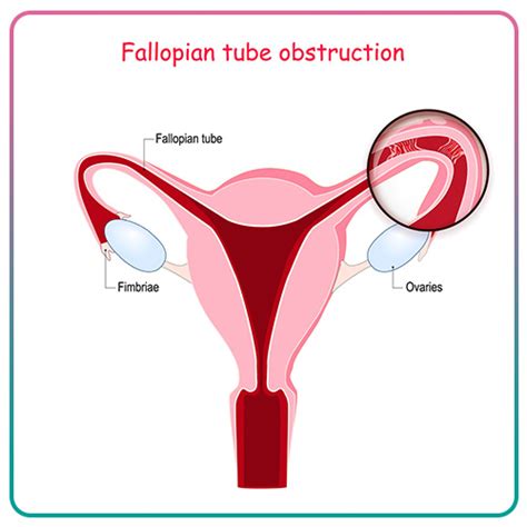 Fallopian Tube Pregnancy Problems