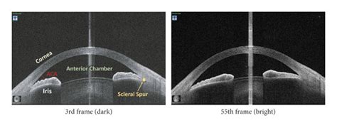 The Example Of A Angle Closure And B Open Angle Normal Video Download Scientific Diagram