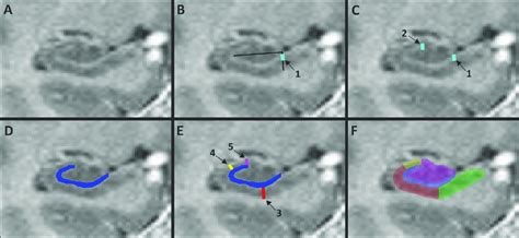 Segmentation Of Hippocampal Subfields Using In Vivo Mri Subfield Download Scientific Diagram