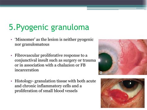 Conjunctival Tumors Pptx