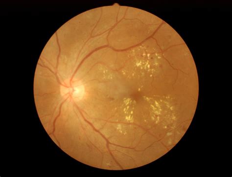 Fundus Photo Revision E Module Diabetic Retinopathy Screening Course