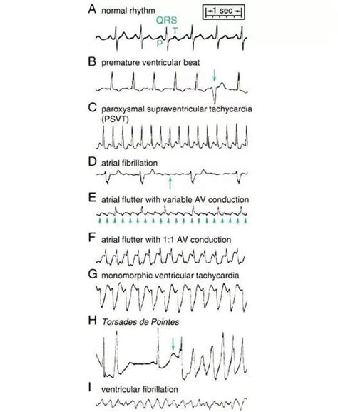 Sinus Tachycardia Normal Sinus Rhythm Ekg Sinus Tachycardia Litfl Ecg