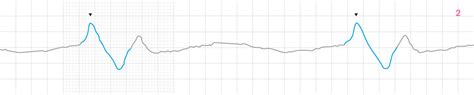 Agonal Rhythm Skillstat Agonal Rhythm Skillstat