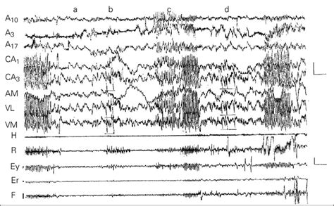 Three Spike Wave Discharge Swd Bursts Accompanied By Clonic Movements Download Scientific