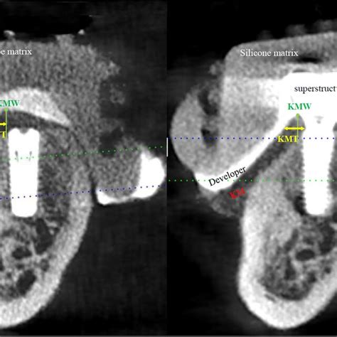 Cbct Image Of The Mixed Impression And Contour Of The Keratinized