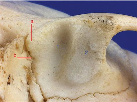 Mandibular Fossa Low Condylectomy And Functional Therapy Alone For