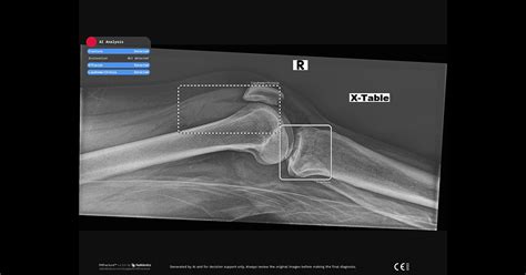 Lipohemarthrosis Detection In X Ray Imaging With Rbfracture™