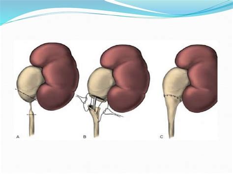 Lap Pyeloplasty Pptx Digestive Disorders Diseases And Conditions