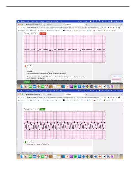 Starn Ekg Test For Hca Lethal And Non Lethal Rhythms Stuvia Us