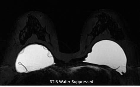 Mri Intracapsular Rupture Breast Rads