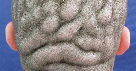 Condition Makes Man S Scalp Look Like Surface Of Brain