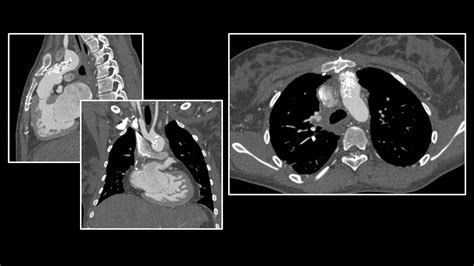 Pediatric Applications Of Photon Counting Ct Siemens Healthineers Usa