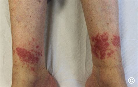 Exercise Induced Vasculitis