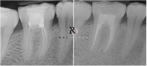 Raj Dubal On Linkedin Endodonticretreatment Endoretreatment Endoprecision Endoquality
