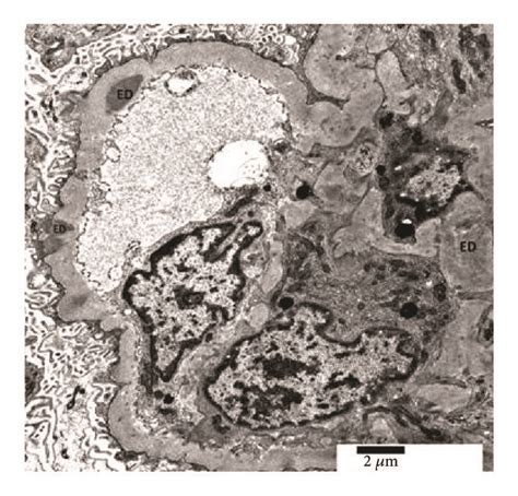 There Is Mesangial Hypercellularity And Mild Thickening Of Glomerular Download Scientific