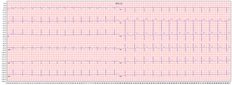 Examples Of Left Posterior Fascicular Block Lpfb Ecg Library