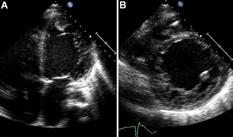 Examination Of Isolated Ventricular Noncompaction Hypertrabeculation
