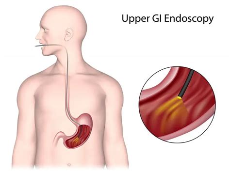 Different Types Of Endoscopy Gastroenterology Practice Located In Trinity FL Bay Area