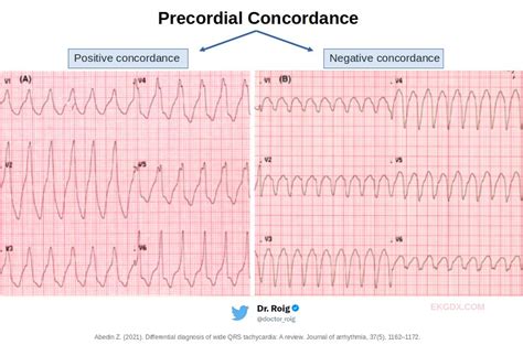 1 Today S Is About VT Versus SVT With Aberrancy The Aim Of This Thread Is To Provide