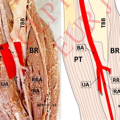 Radial Artery