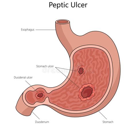 Peptic Ulcer Disease Structure Medical Science Stock Illustration