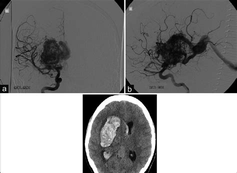 Angiographic Images Digital Subtraction Angiography DSA Download Scientific Diagram