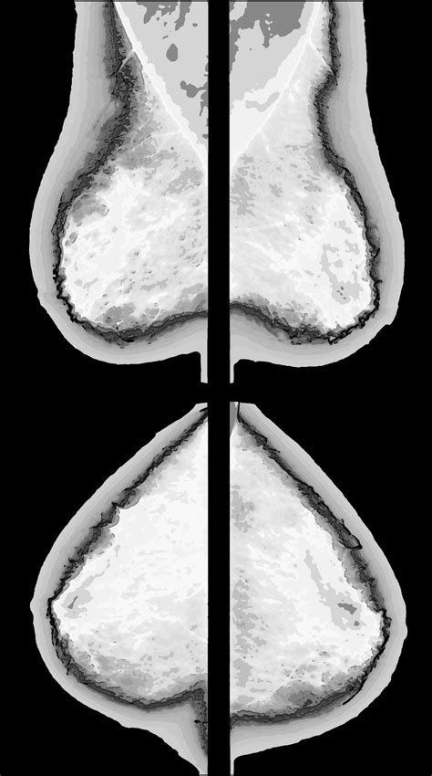 Segmentation Of The Mammogram According To Mixture Model Components