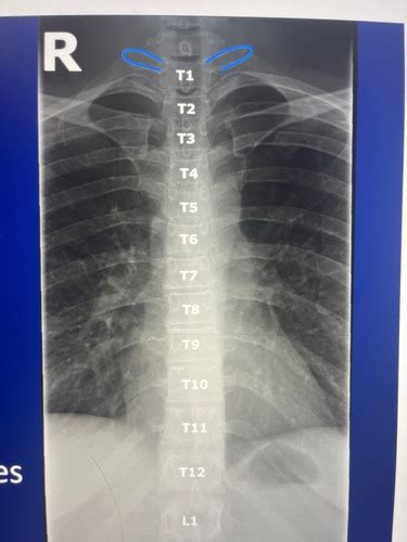 Thoracic Spine Flashcards Quizlet