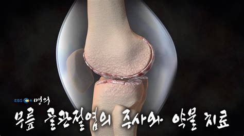[명의 의학백과📖]무릎 골관절염의 주사와 약물 치료 Youtube