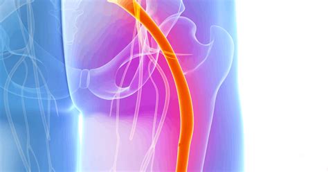 Chiropractic Treatment Better For Sciatica After Unsuccessful Surgery