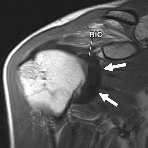 Rotator Interval Capsule Anatomy At Benjamin Ferguson Blog