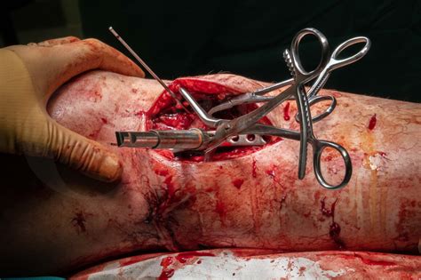 Tibial Plateau Fracture Fixation Of A Bicondylar Fracture With A Dual Incision Technique Smith