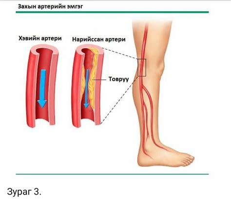 Судас хатуурал гэж юу вэ Хүний биеийн артерийн судасны дотор хананд өөхөн дуслууд хуримтлагдаж