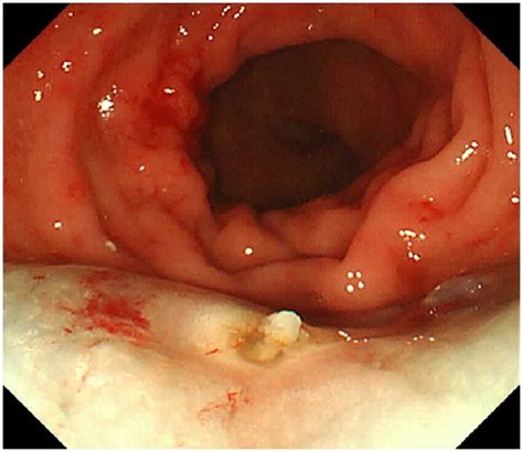 After Endoscopic Mucosal Resection Of The Polyp Download Scientific Diagram