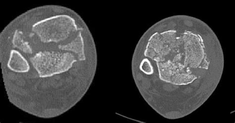 Tibial Fractures Plateau Shaft And Pilon Orthosho