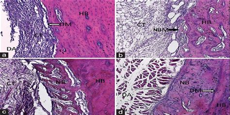 Reconstruction Of Mandibular Defects Using Synthetic Octacal Dental Research Journal