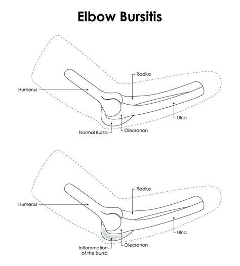 Premium Vector Elbow Bursitis Radius Humerus Normal Bursa Olecranon Ulna Inflammation Of The