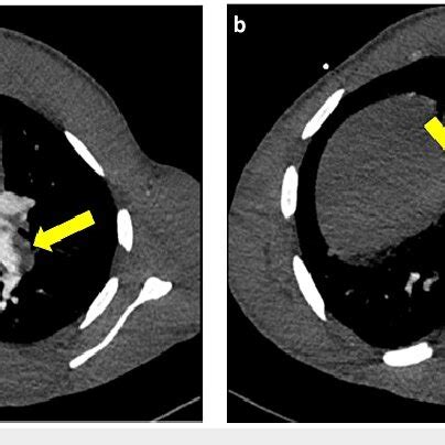 CT Angiogram CT Computed Tomography PE Pulmonary Embolism A CT Download Scientific Diagram